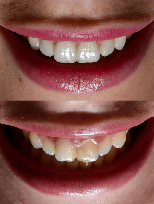 Perfect Teeth With Veneers In Tomball From Dr. James Geer - James Geer DDS